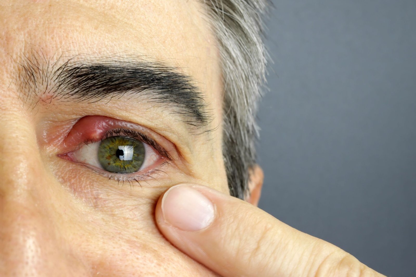 Terçol: significado espiritual, causas físicas, causas emocionais e ...